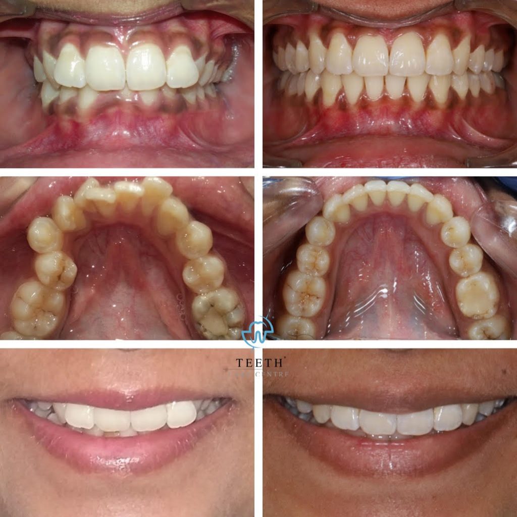 Invisalign Clear Aligner Clinic in Ahmedabad - Invisalign