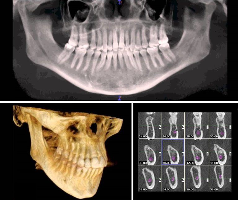 Painless Tooth Extraction in Ahmedabad - Extraction