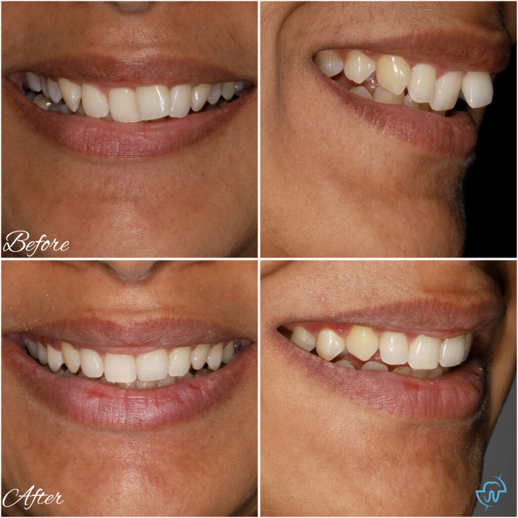 Invisalign Clear Aligner Clinic in Ahmedabad - Invisalign