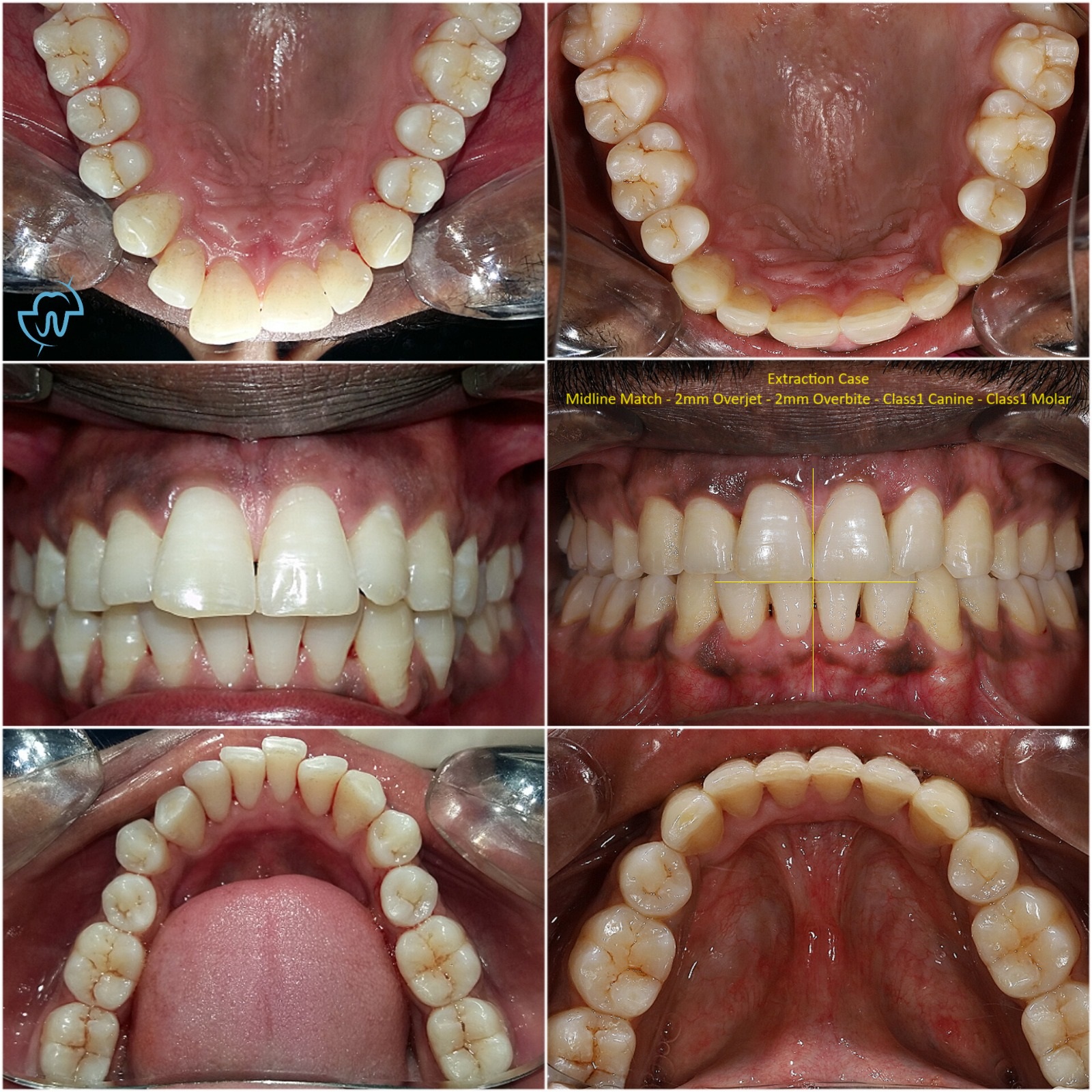 Invisalign Clear Aligner Clinic in Ahmedabad - Invisalign