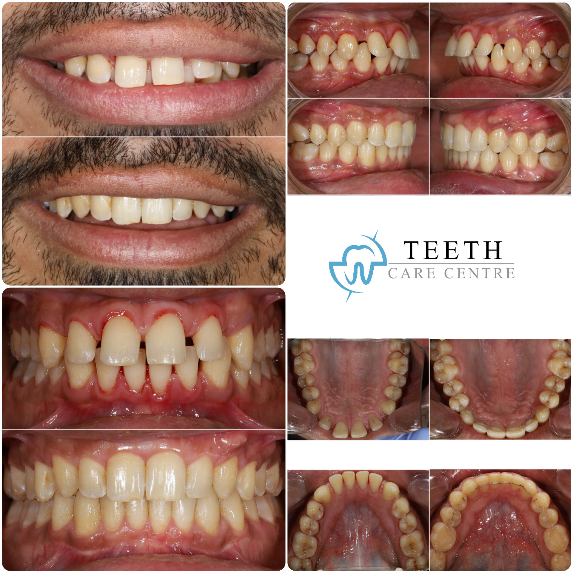 Invisalign Clear Aligner Clinic in Ahmedabad - Invisalign